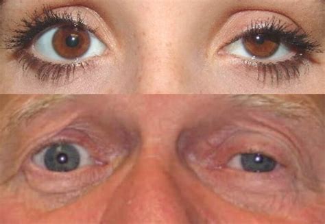 Arterial Dissection Stroke Manual