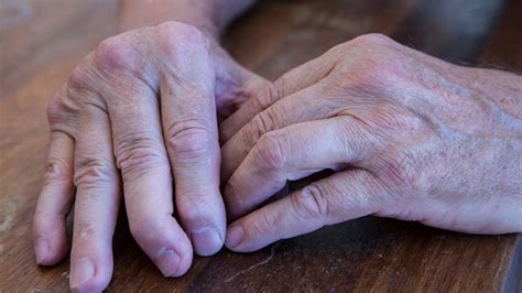 The 5 Types Of Psoriatic Arthritis
