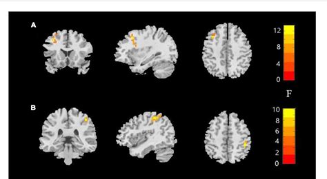 Figure 1 From Intrinsic Brain Abnormalities In Female Major Depressive