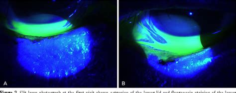 Figure 1 From A Case Of Acute Idiopathic Bilateral Lower Lid Ectropion Semantic Scholar