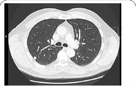 Computed Tomography Scan Showing A Right Pulmonary Nodule Download