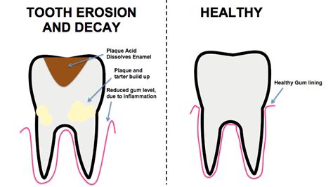 Cavities On Front Teeth Why Do We Get Them What Are Your Options