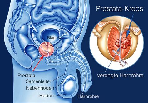 Cancer De Prostata