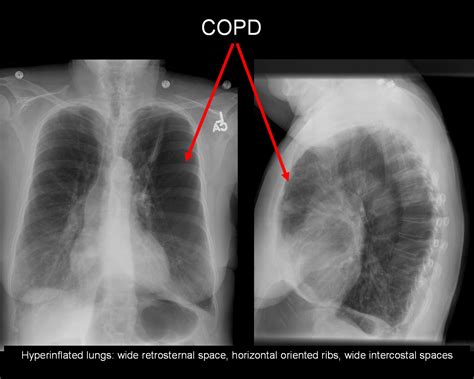 What Is Hyperinflated Lung Fields At Willy Booth Blog