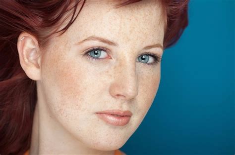 Are Freckles Ephelides Considered A Type Of Skin Growth