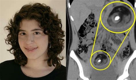 “외계인 머리 아니야” 종양서 치아 자라난 10대 소녀 정체 뭐였을까