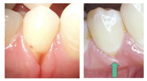 Hard Tissue Exam Icdas Caries Classification Flashcards Quizlet