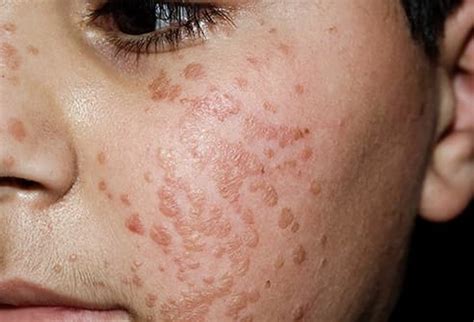 Warts Pictures Causes Types Removal And Treatment