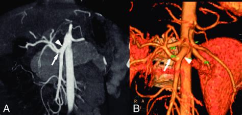 Michels Type Ix Anatomy A Mip Image B Vr Image The Main Hepatic Download Scientific