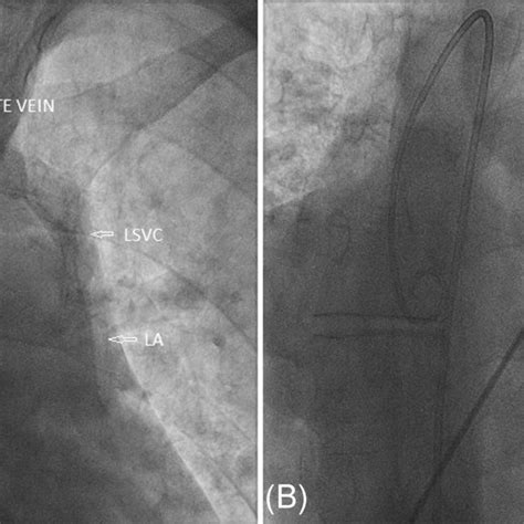 Central Venogram Depicting Absent Right And Persistent Left Svc Download Scientific Diagram