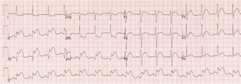 Esc Stemi Guidelines 2017 Was Ist Neu Was Ist Geblieben Foamina
