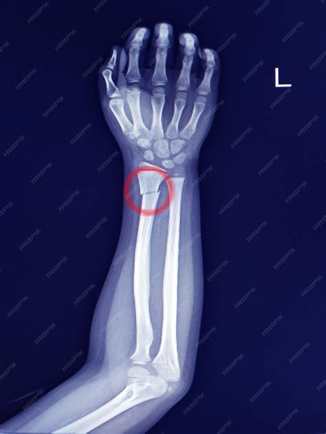 Radiografía Del Antebrazo Fractura Del Eje Distal Del Radio