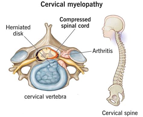 Cervical Spine Spinal Canal Abcs Of The Degenerative Spine Insights