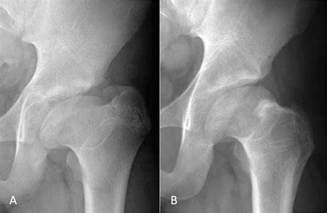Treating Symptomatic Residual Hip Deformity In Legg Calvé Perthes