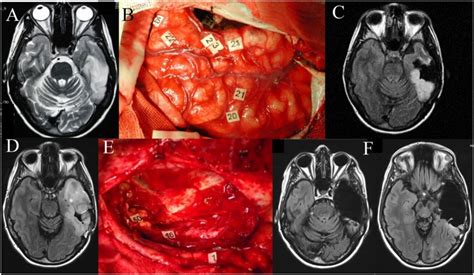 Network Plasticity And Intraoperative Mapping For Personalized Multimodal Management Of Diffuse