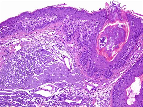 Bowens Disease Pathology Outlines