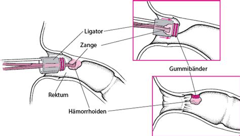 Hämorrhoiden Hämorrhoiden Msd Manual Ausgabe Für Patienten