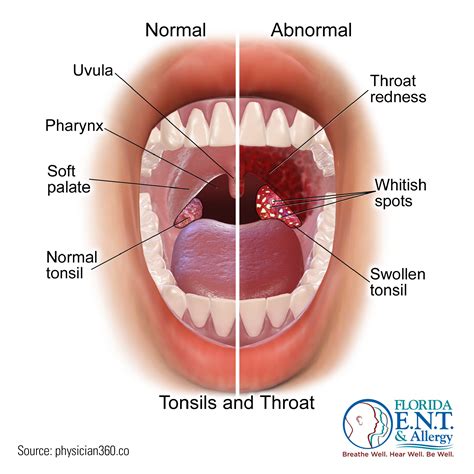 Allergy Throat