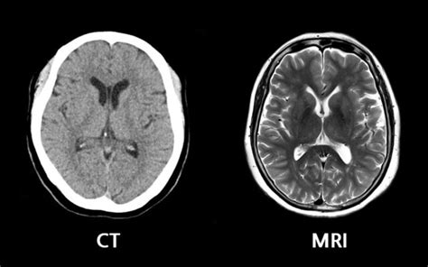 뇌 Ct와 Mri의 차이점과 Ct 검사를 해야 하는 경우 100 Age Health