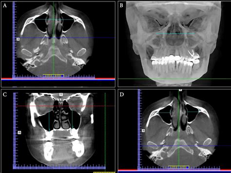 The Relationship Between Optic Nerve And Onodi Cells On Ct Scan