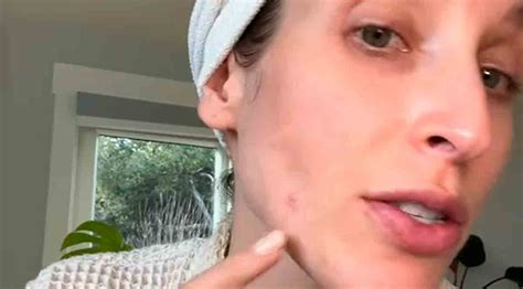 Video Dermatologist Reveals The Type Of Pimple You Should Never Pop