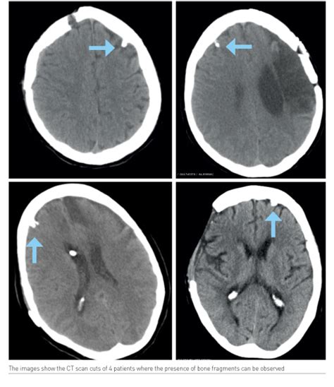Multimodal Neuromonitoring Catheter Insertion
