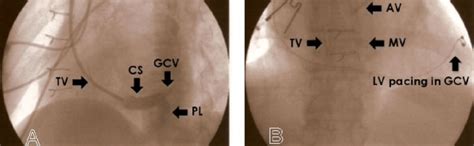 A Left Side A 60 Degree Left Anterior View Showing Coronary Sinus