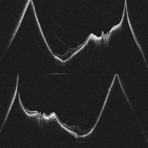 B Scan Oct Showing A Full Thickness Macular Hole In A High Myopic