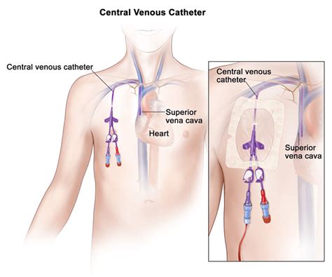 What Do Broviac And Hickman Catheters Do
