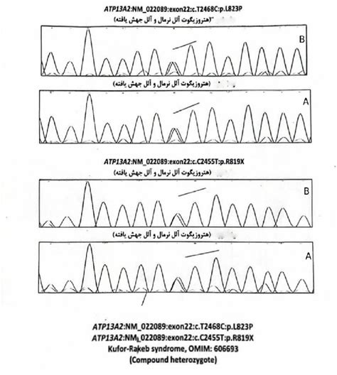 Exome Sequencing Of The Case A And His Brother B Download