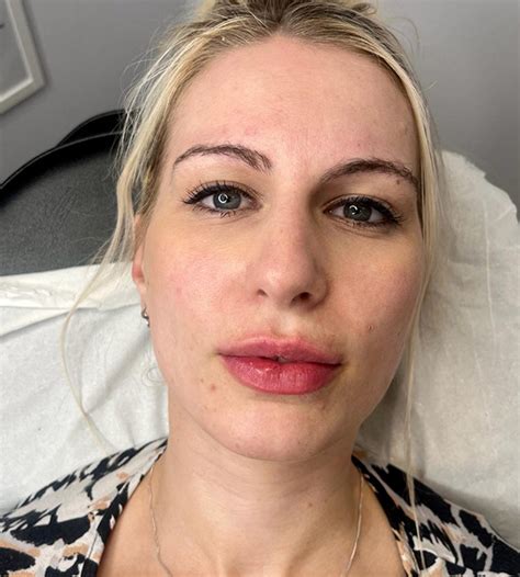 Lip Fillers Beautivine Aesthetics
