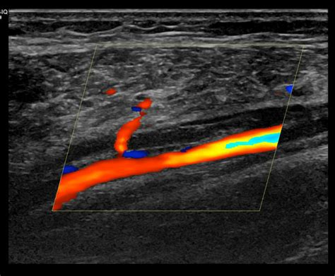 Venous Doppler Cpt Code 2025 John Holt