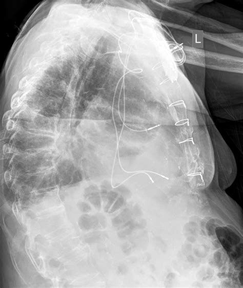 Biventricular Pacemaker Chest X Ray Biventricular Pacemaker Chest X Ray