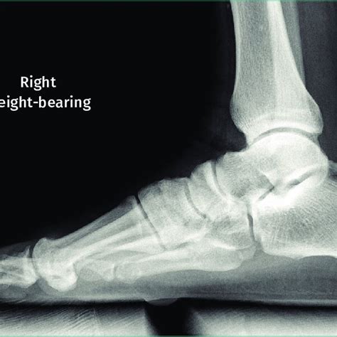 Plain Radiography Sagittal View With Weight Bearing Moderate Download Scientific Diagram