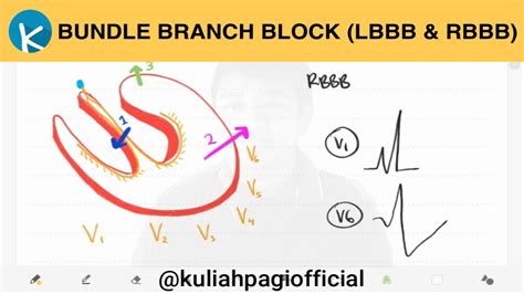 Ekg Dasar 18 20 Bundle Branch Block Lbbb Dan Rbbb Youtube