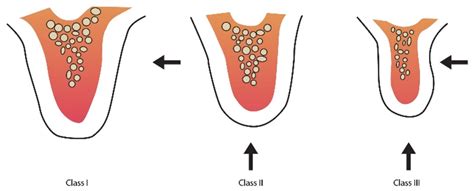 Ridge Defect Classification Of Edentulous Patients According To Seibert