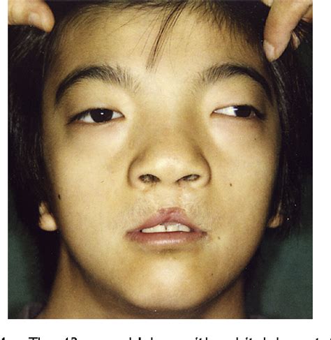Figure 1 From A Case Of Orbital Hypertelorism With Recovery Of Binocular Vision After Surgical