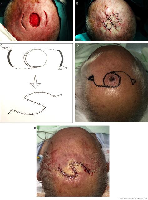 Reconstruction Of Moderate Sized Scalp Defects A 1 2 3 Rule Actas Dermo Sifiliográficas