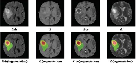 Illustrations Of Mri Brats 2020 Images Flair T1 Tice And T2 With The Download Scientific