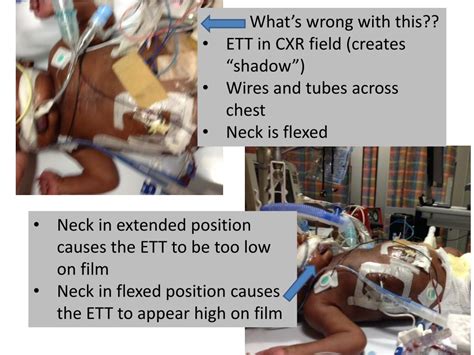 Ppt Proper Positioning For Cxr Powerpoint Presentation Free Download