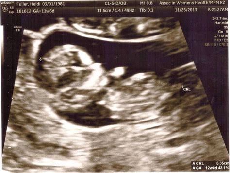 So Much More 11 Weeks And 4 Days