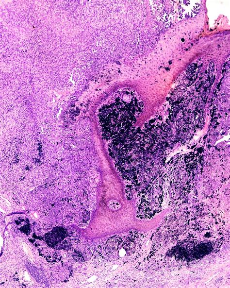 Intradermal Pigmented Nevus Photograph By Jose Calvoscience Photo