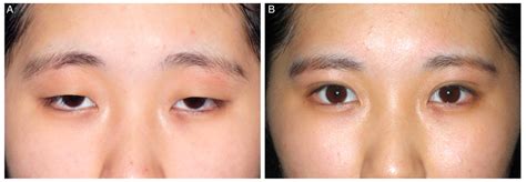 Asian Blepharoplasty Incisional Vs Non Incisional