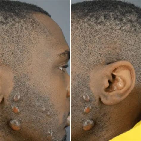 Factors That Predispose You To Keloids