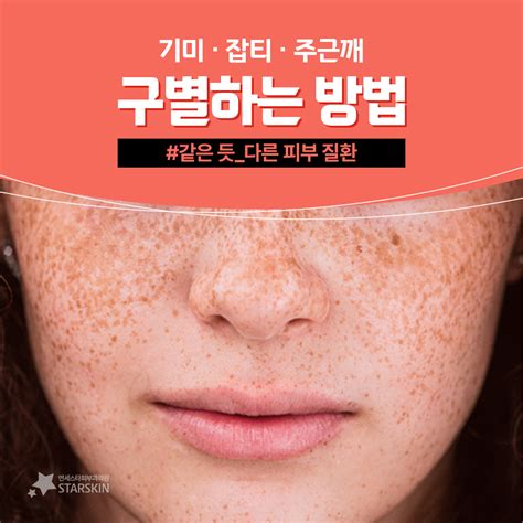 신촌연세스타피부과의원 기미 잡티 주근깨 구별하는 방법 🧐 다 똑같아 보이지만 전부 다른 기미