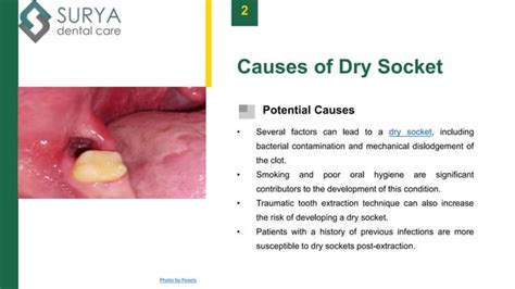 Dry Socket Vs Normal Socket Surya Dental Care Ppt
