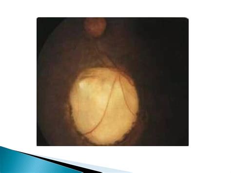 Retinal Lesions Pathophysiology Ppt