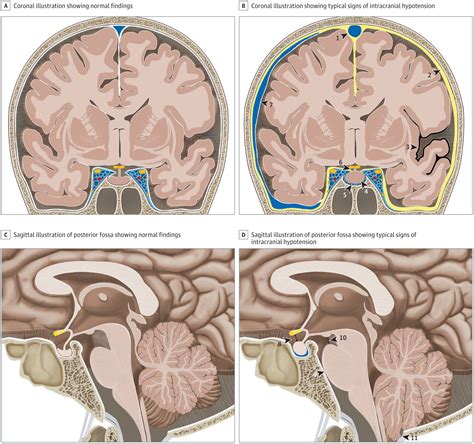 Assessing Spinal Cerebrospinal Fluid Leaks In Spontaneous Intracranial