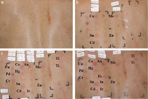 Results Of Patch Tests A Upper Back Before Patch Testing B