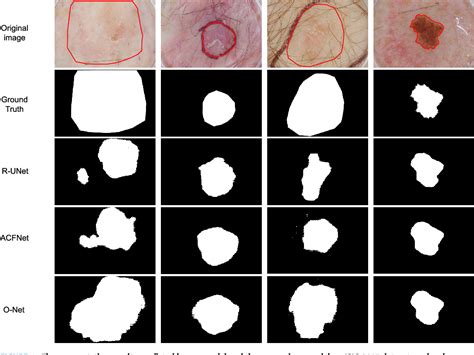 Figure 4 From Skin Lesion Segmentation Using Recurrent Attentional Convolutional Networks